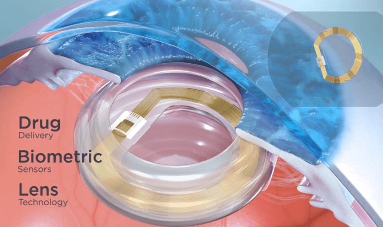 Gemini Refractive Capsule (Omega Ophthalmics) | IOLS Directory